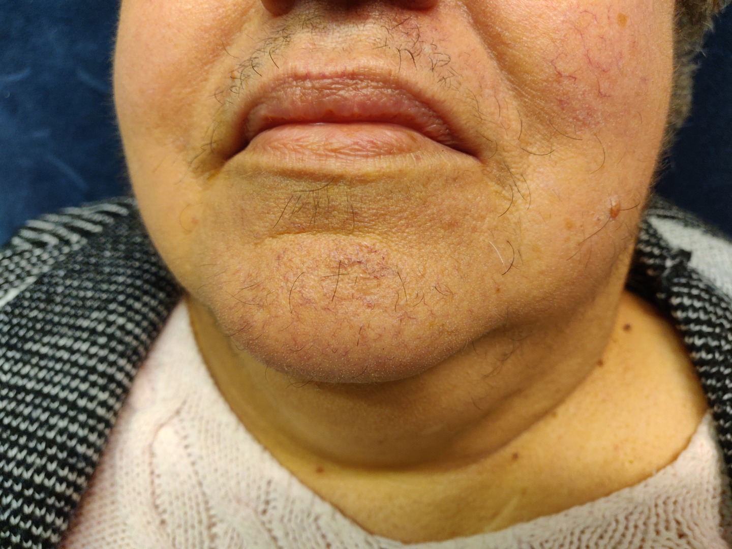 Dermedicare | Huid- en oedeemtherapie - Ongewenste haargroei